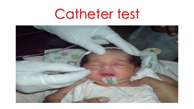 3. choanal atresia