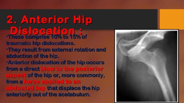 3. hip dislocations