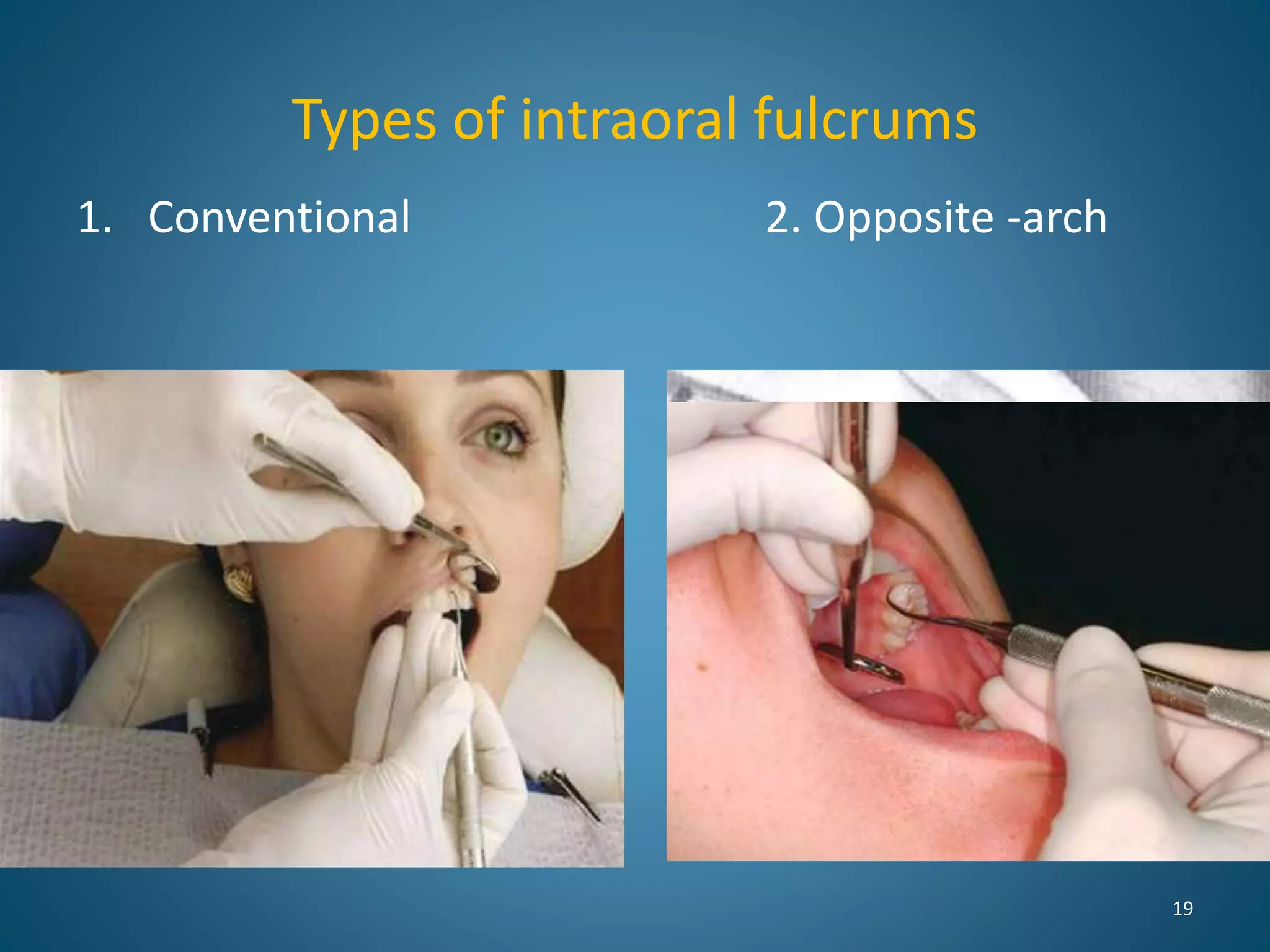 Periodontics - Mirror and Finger rests | PPTX