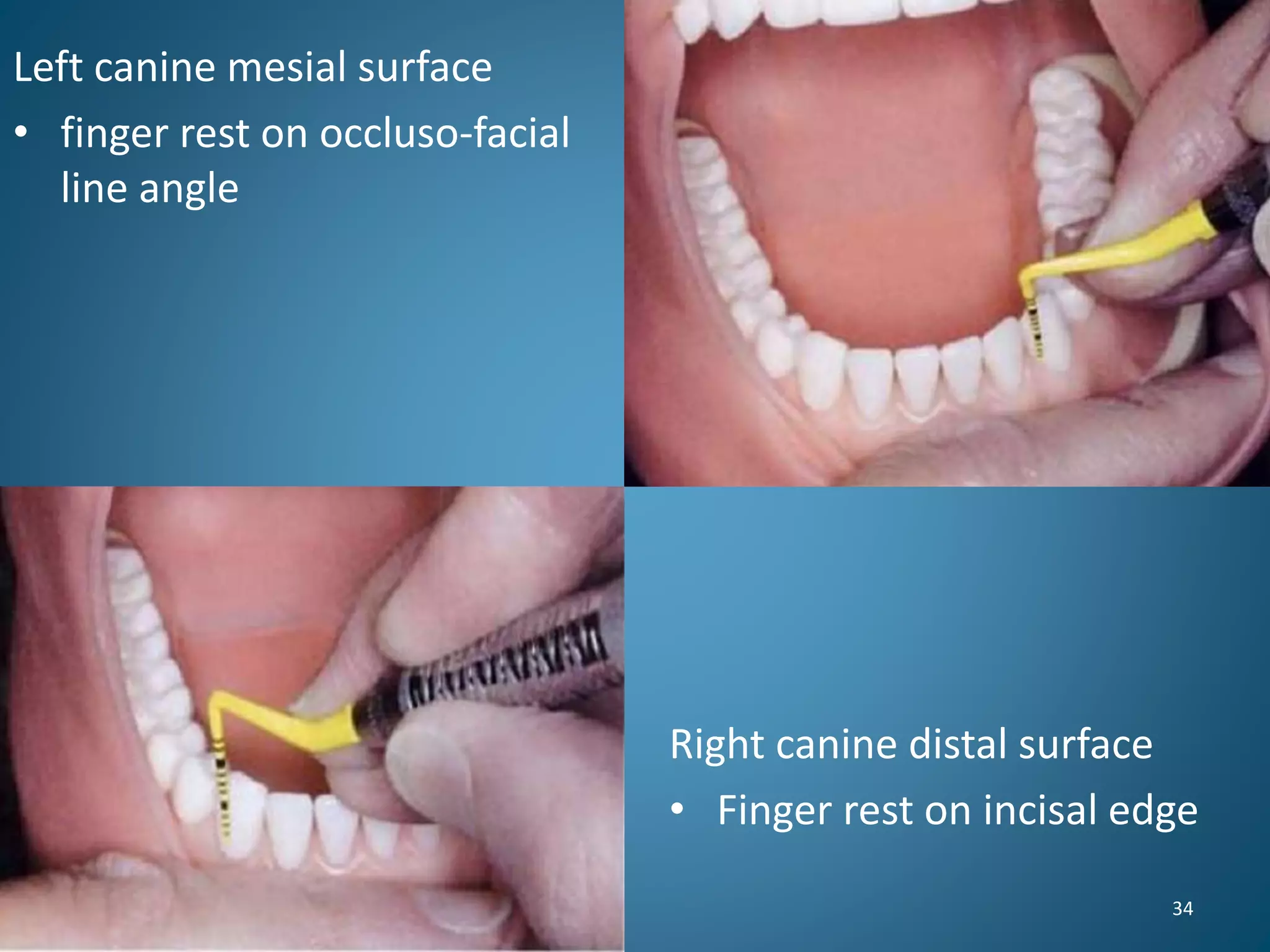 Periodontics - Mirror and Finger rests | PPTX