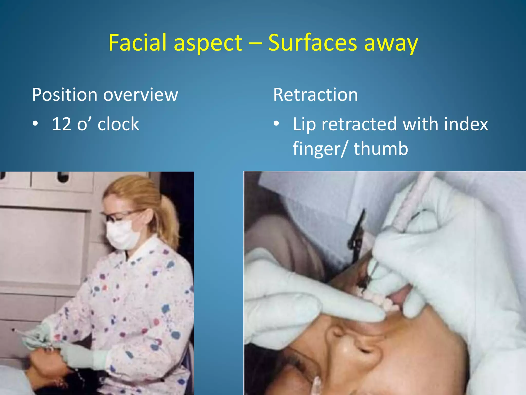 Periodontics - Mirror and Finger rests | PPTX