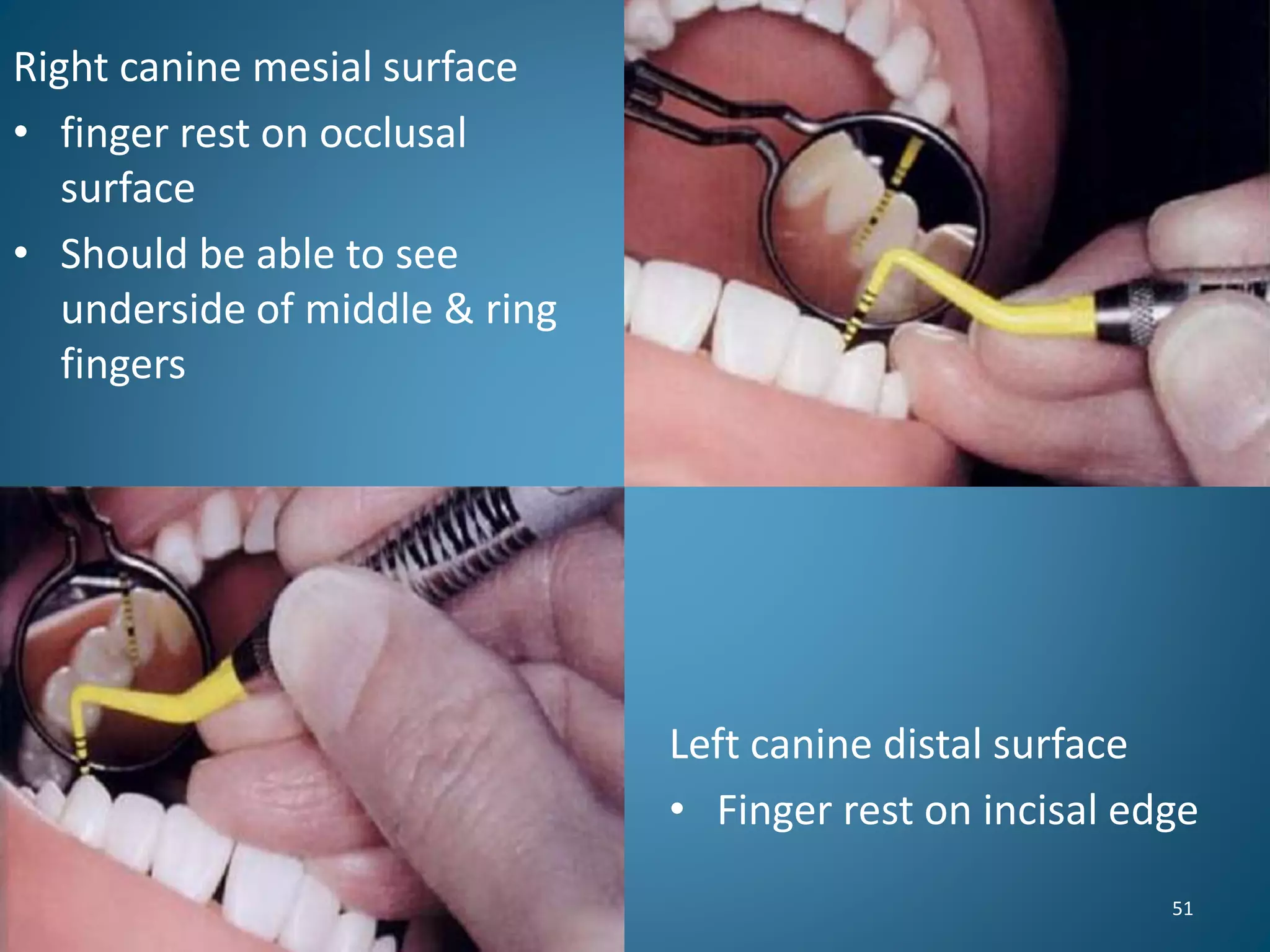 Periodontics - Mirror and Finger rests | PPTX