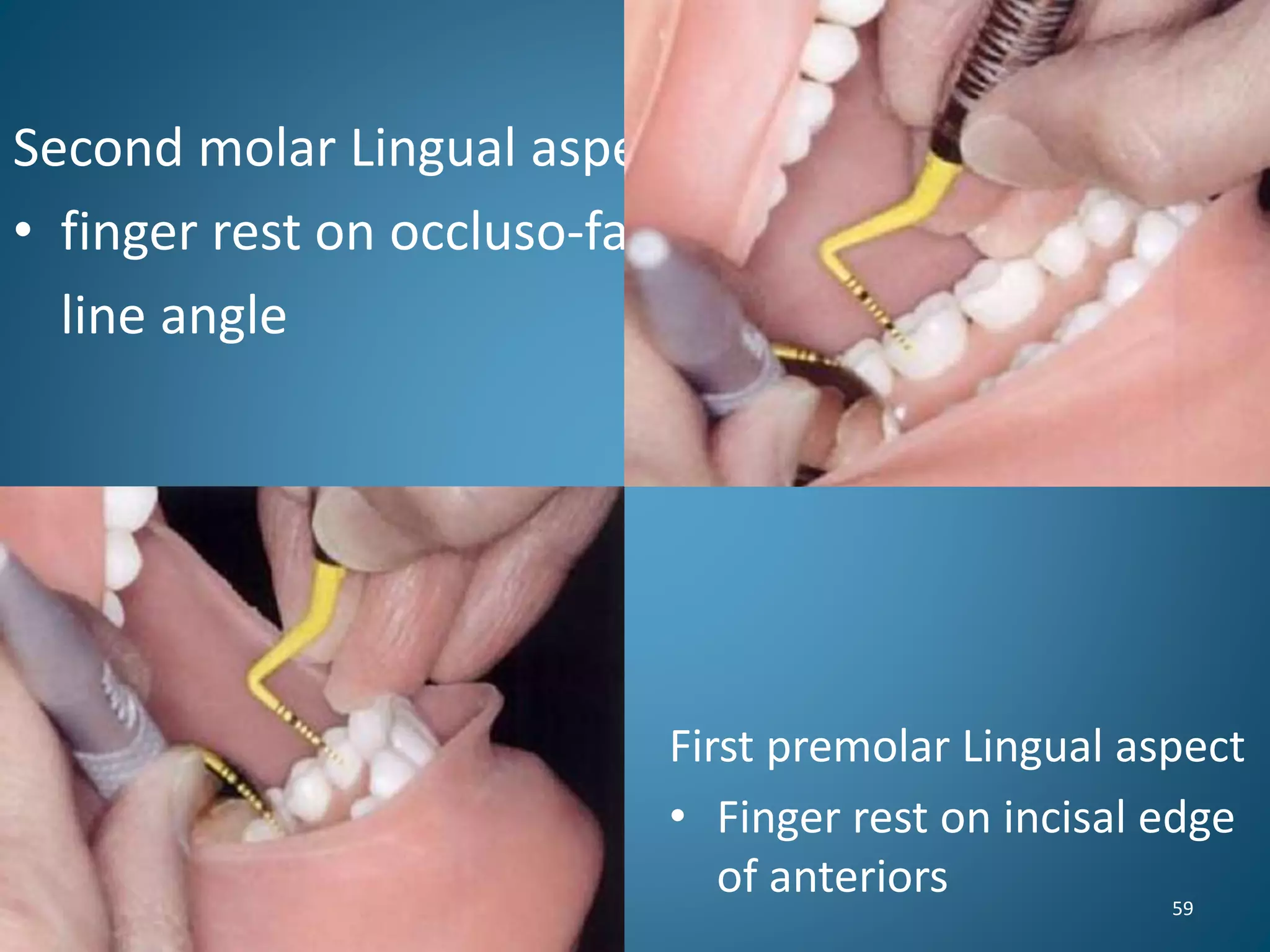 Periodontics - Mirror and Finger rests | PPTX
