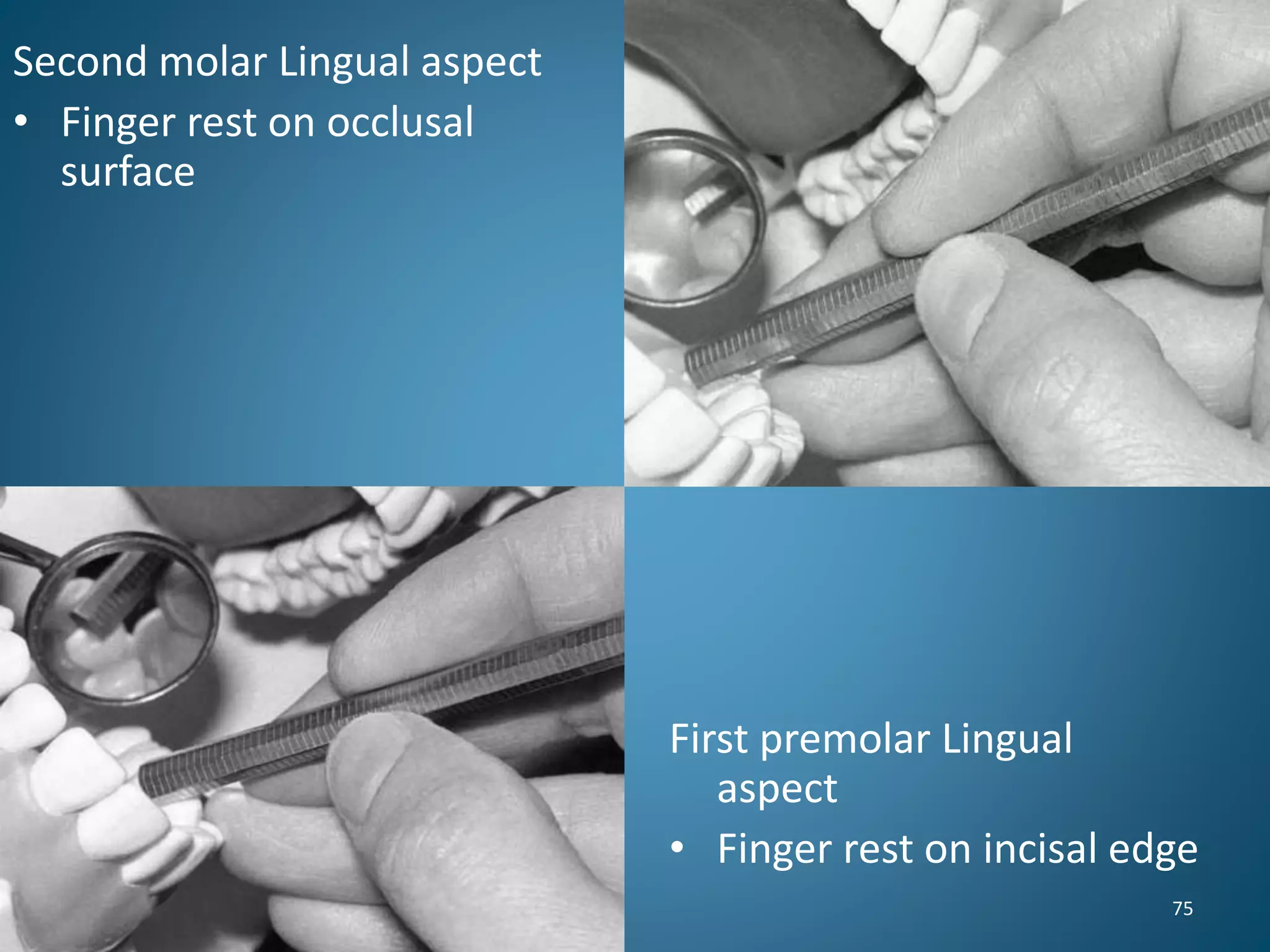 Periodontics - Mirror and Finger rests | PPTX