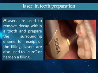 Different techniques for caries removal | PPTX