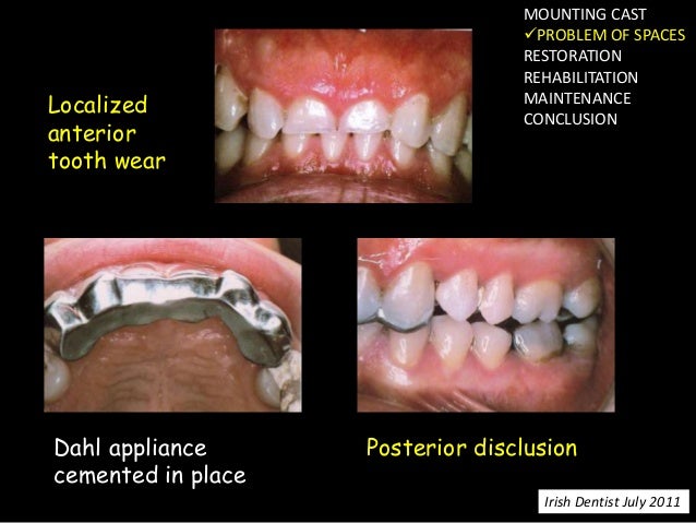 3.treatment planning restorative management of worn dentition (2)