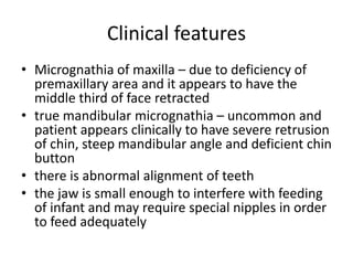 3.micrognathia | PPTX