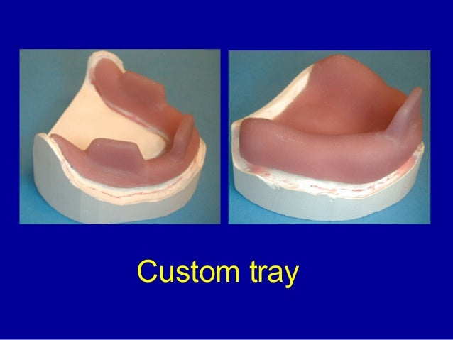 stock trays & diagnostic casts