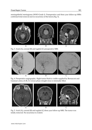 Pineal region tumors | PDF