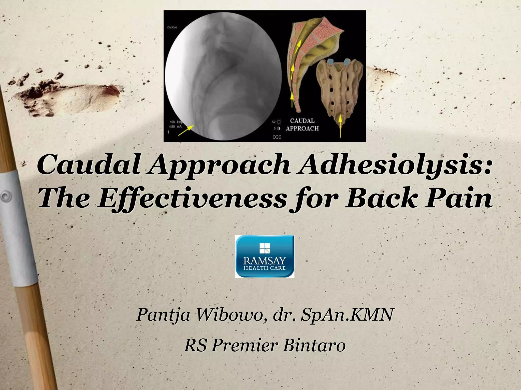 dr. Pantja - Caudal Approach Adhesiolysis for ISAPM 2015 | PPTX