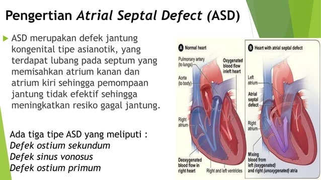 ASKEP ATRIAL SEPTAL DEFECT (ASD) | PPTX