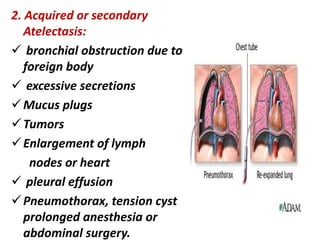 atelectasis | PPTX