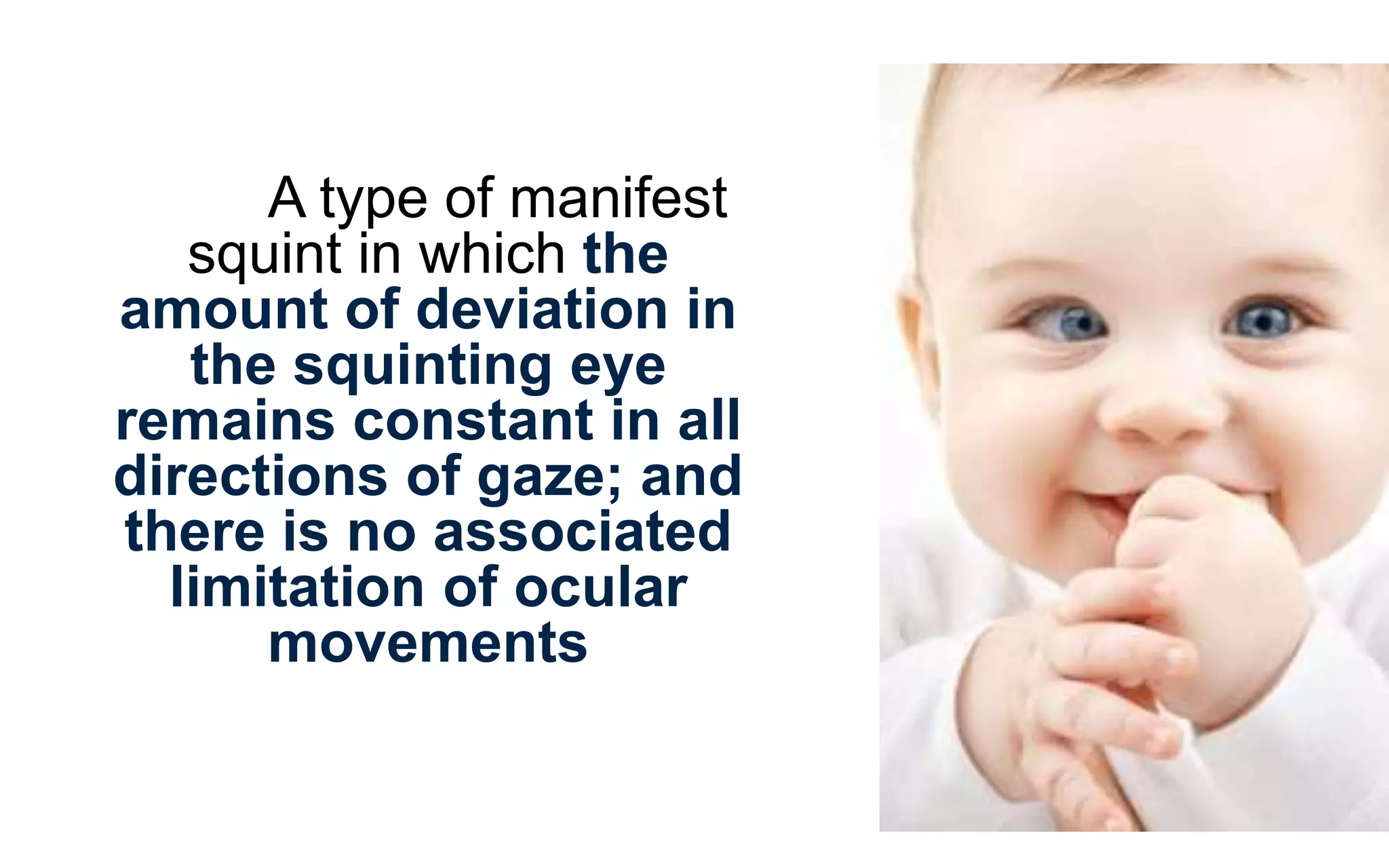 concomitant strabismus | PPTX