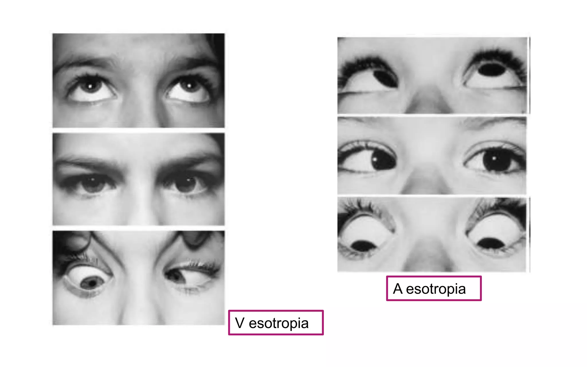 concomitant strabismus | PPTX