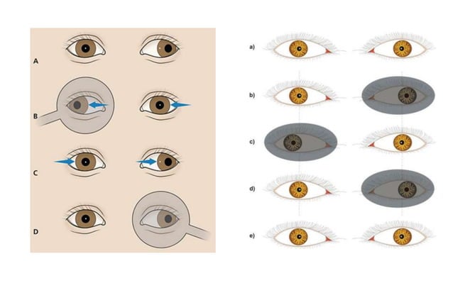 concomitant strabismus