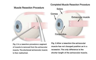 concomitant strabismus | PPTX