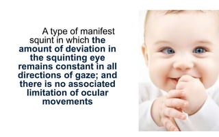 concomitant strabismus | PPTX