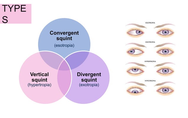 concomitant strabismus | PPTX | Eye and Vision Conditions | Diseases ...