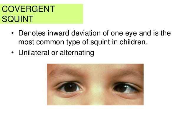 concomitant strabismus