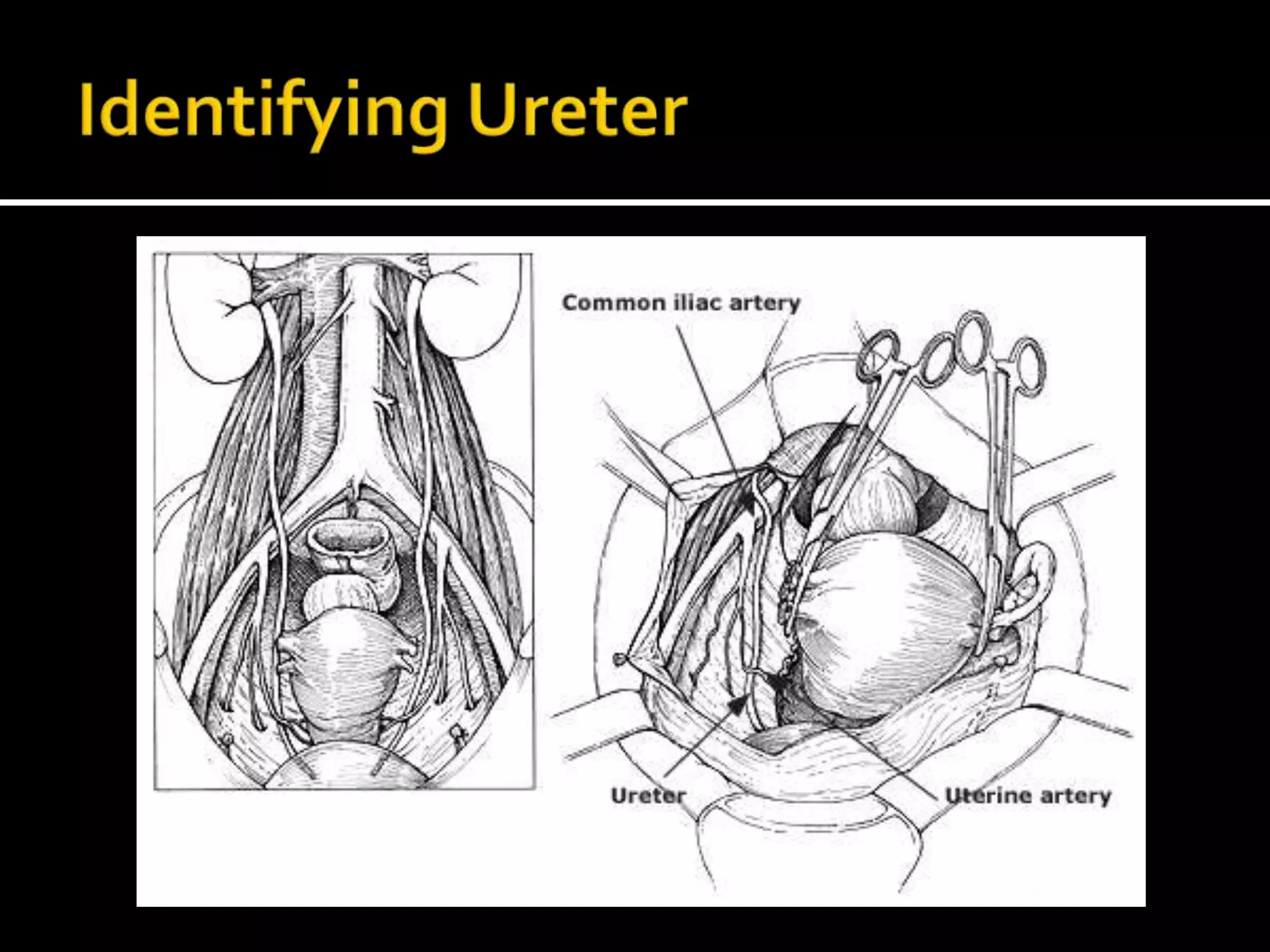 evidence base steps hysterectomy | PDF | Pregnancy | Reproductive Health