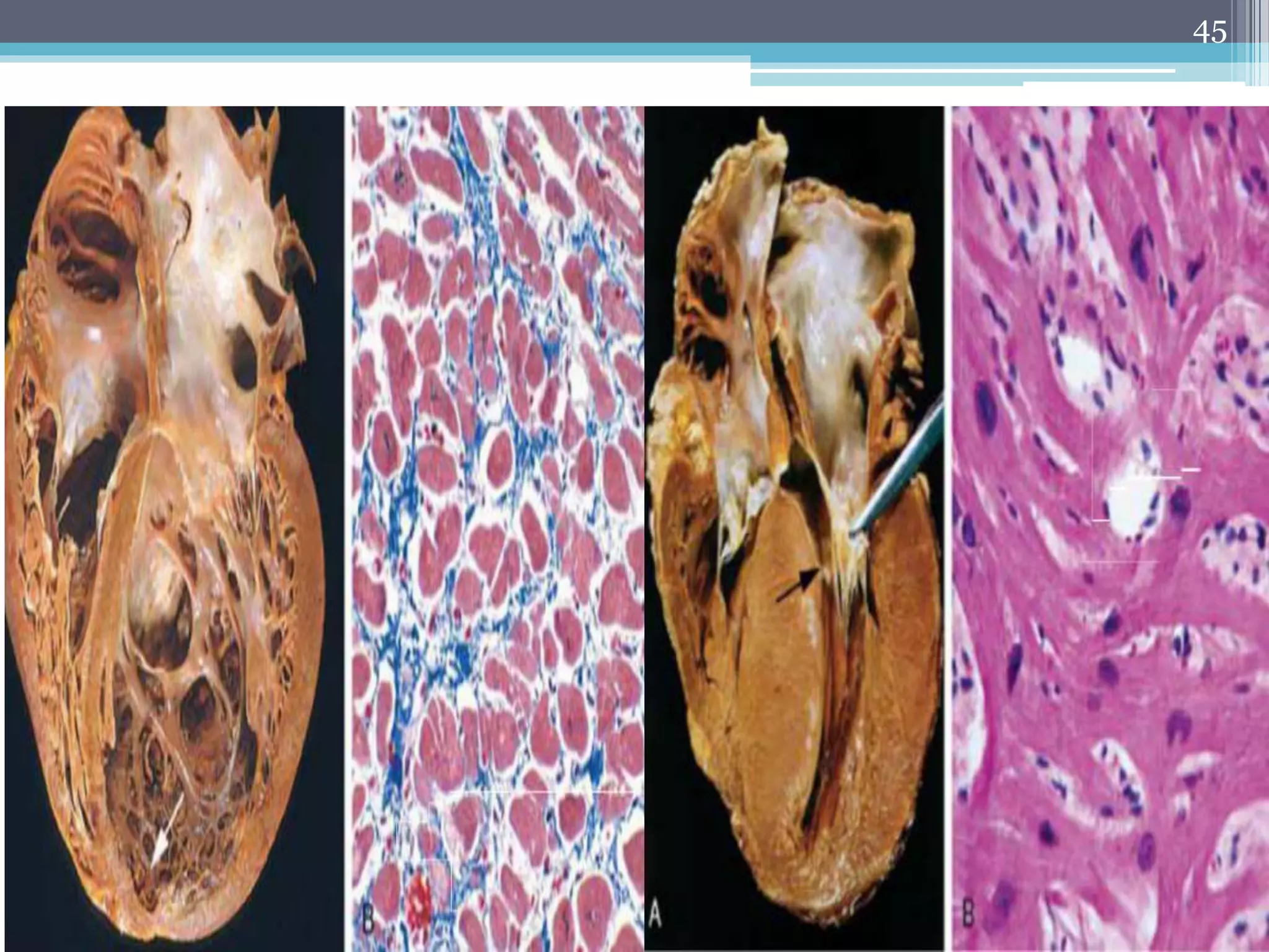 3.pericarditis,miocarditis y endocarditis (patologia del corazón) | PPTX
