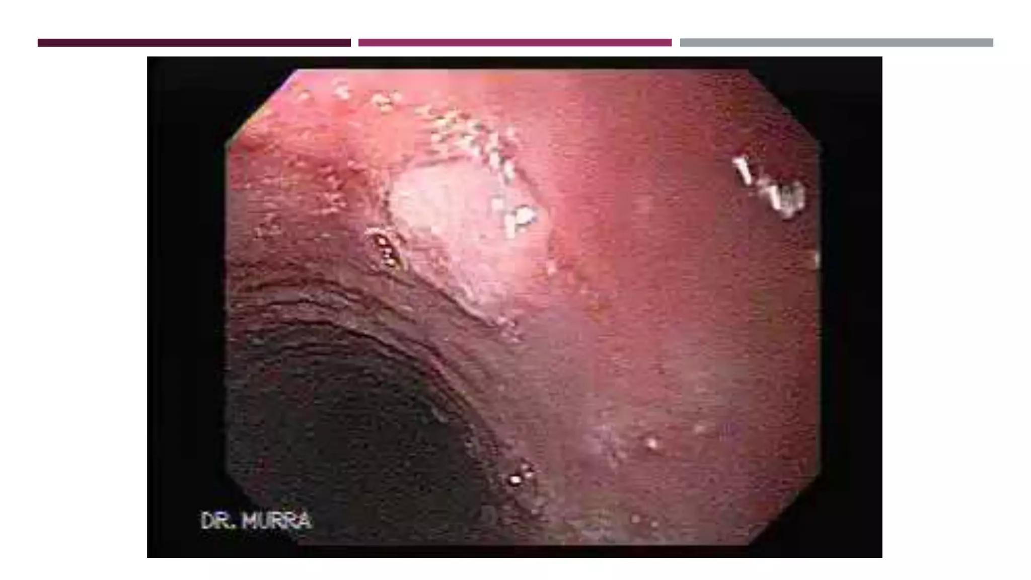 Esofagitis en pacientes inmunocomprometidos, esofagitis por cáusticos y ...