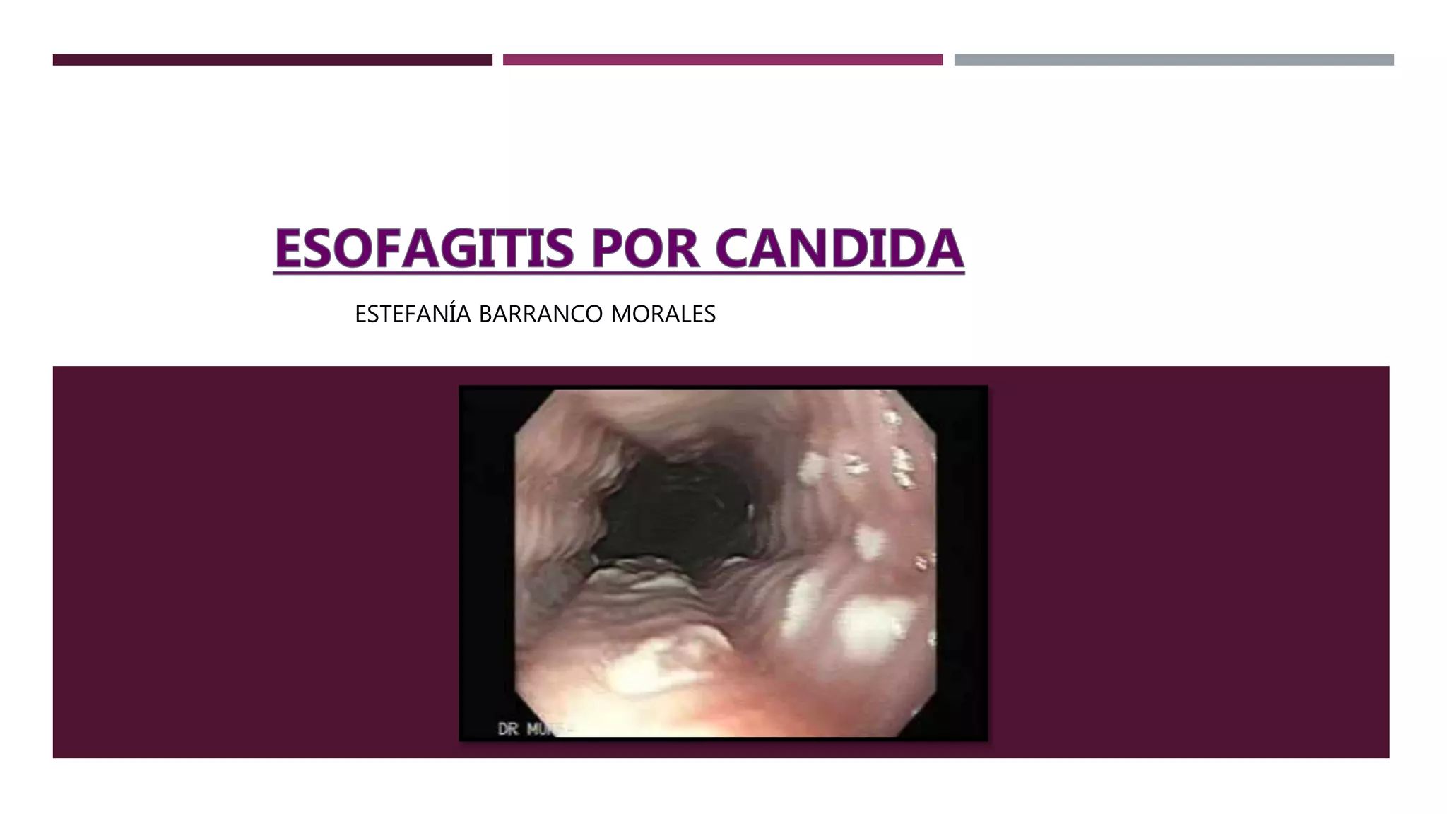Esofagitis en pacientes inmunocomprometidos, esofagitis por cáusticos y ...