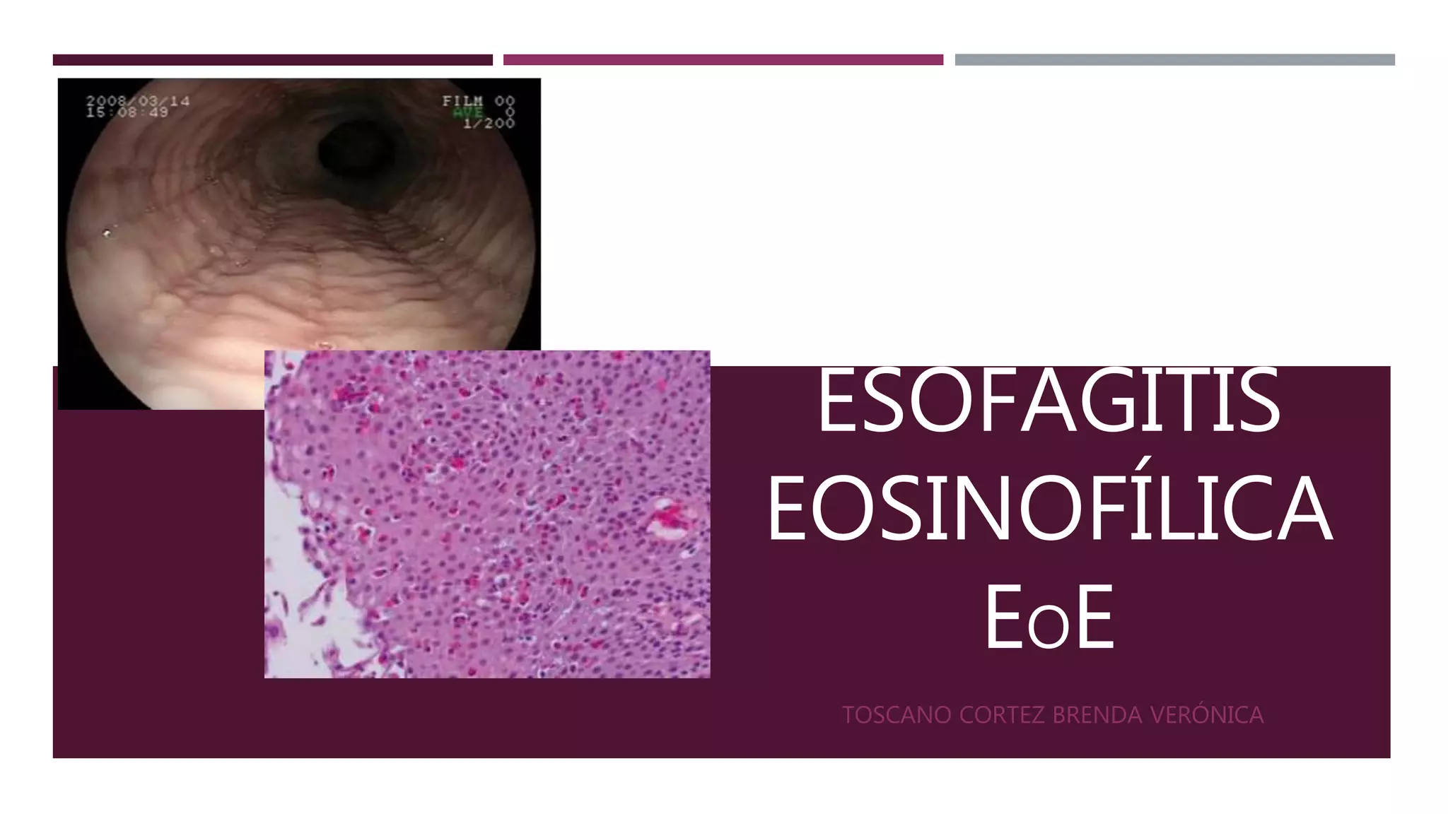 Esofagitis en pacientes inmunocomprometidos, esofagitis por cáusticos y ...