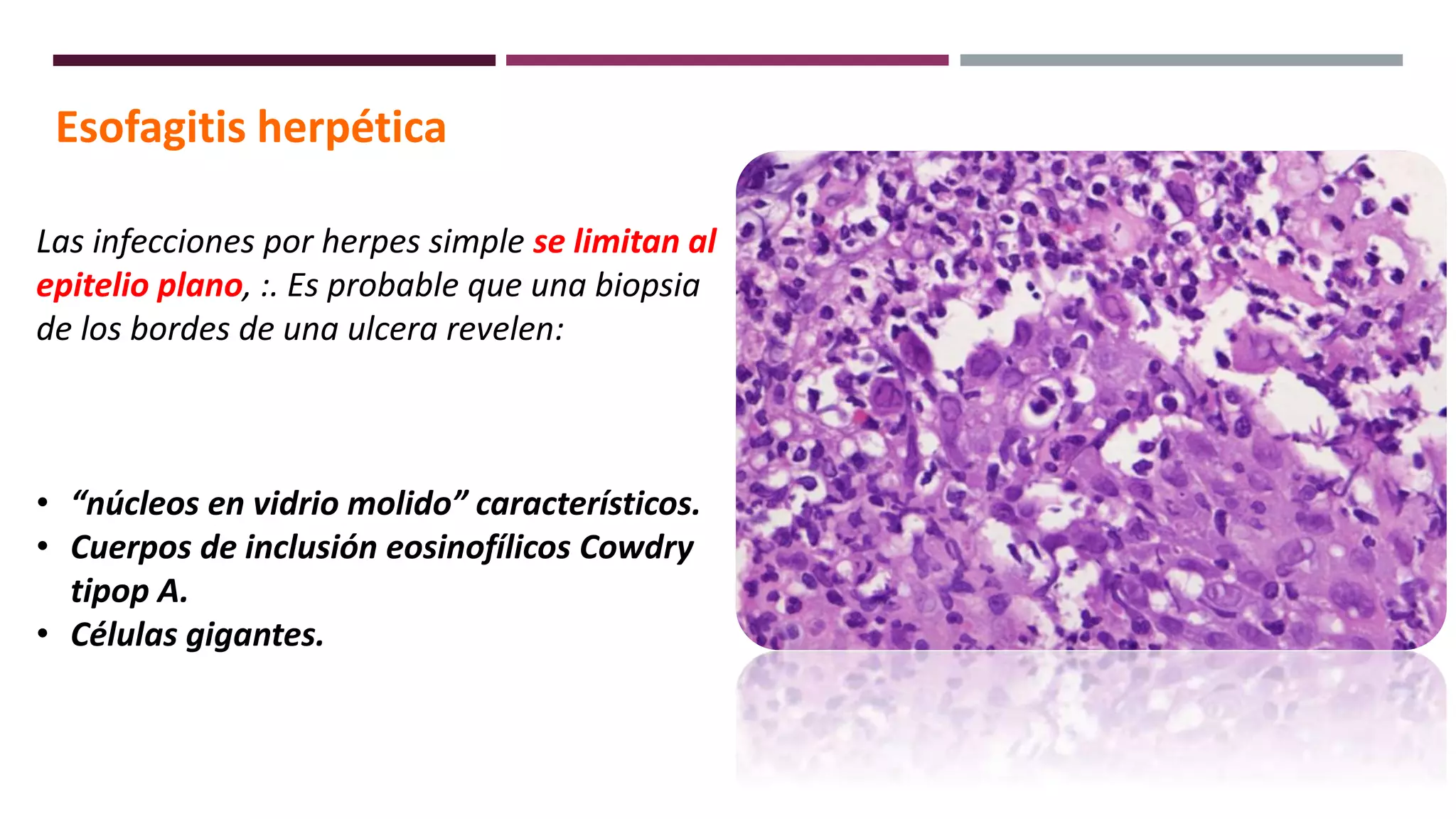 Esofagitis en pacientes inmunocomprometidos, esofagitis por cáusticos y ...