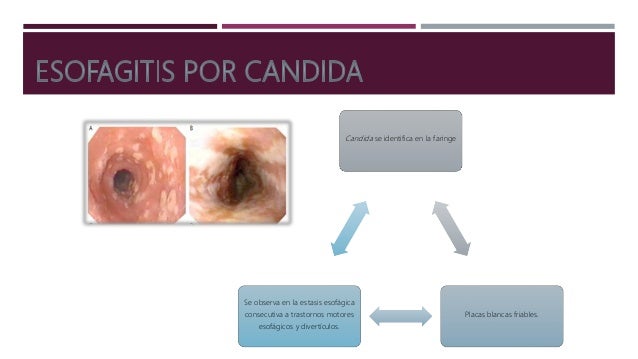 Esofagitis en pacientes inmunocomprometidos, esofagitis por cáusticos…