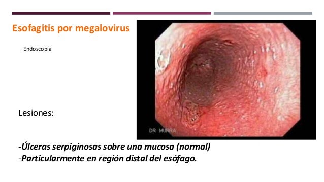 Esofagitis en pacientes inmunocomprometidos, esofagitis por cáusticos…