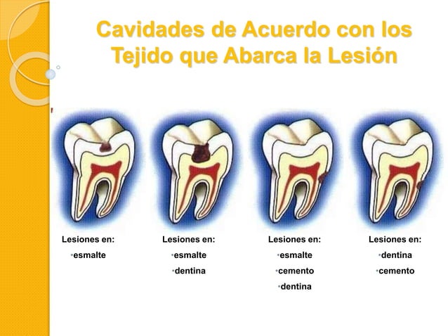 nomenclatura y clasificacion de las cavidades