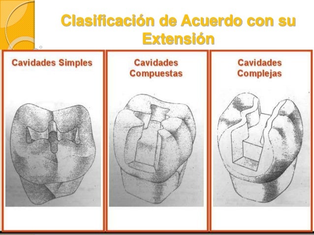 nomenclatura y clasificacion de las cavidades