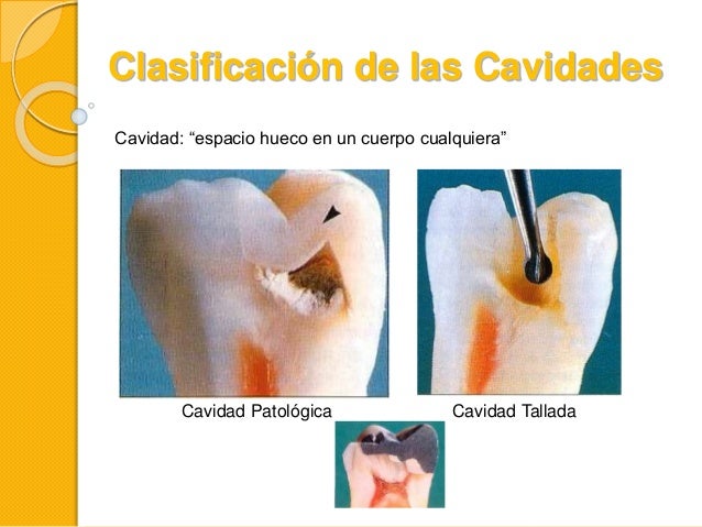 nomenclatura y clasificacion de las cavidades