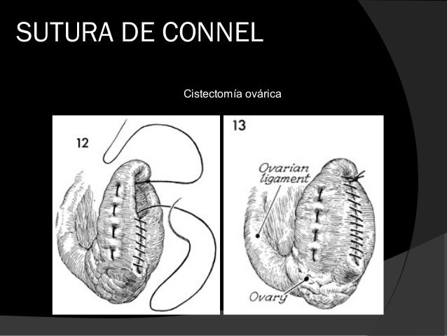 3. sutura quirurgicas lember-cushin