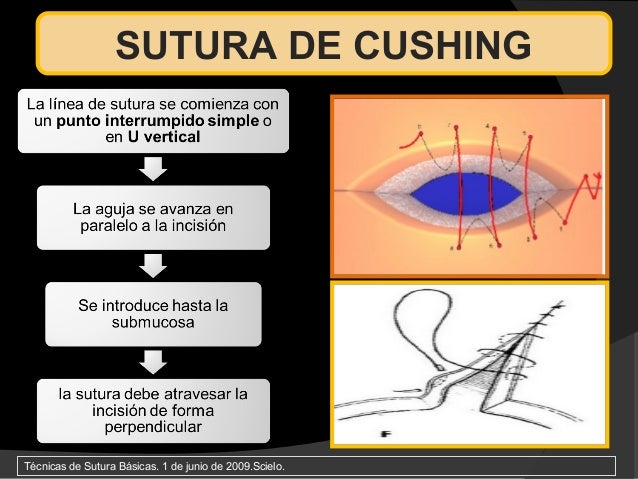 3. sutura quirurgicas lember-cushin