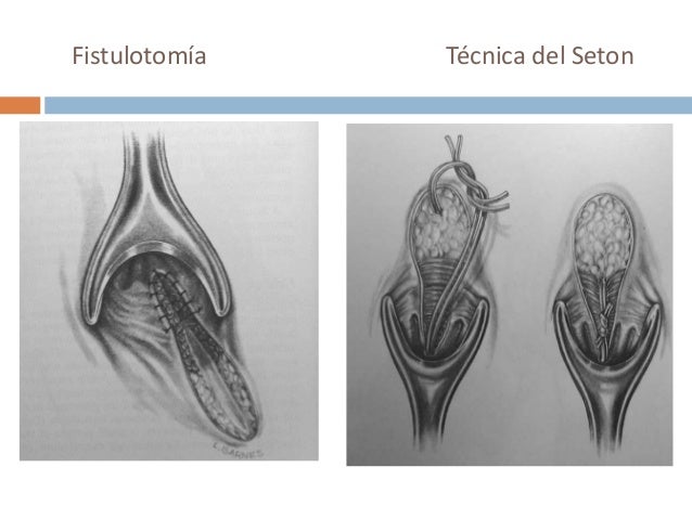 3. patologia quirurgica benigna del ano recto