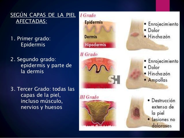Quemaduras Primer Grado