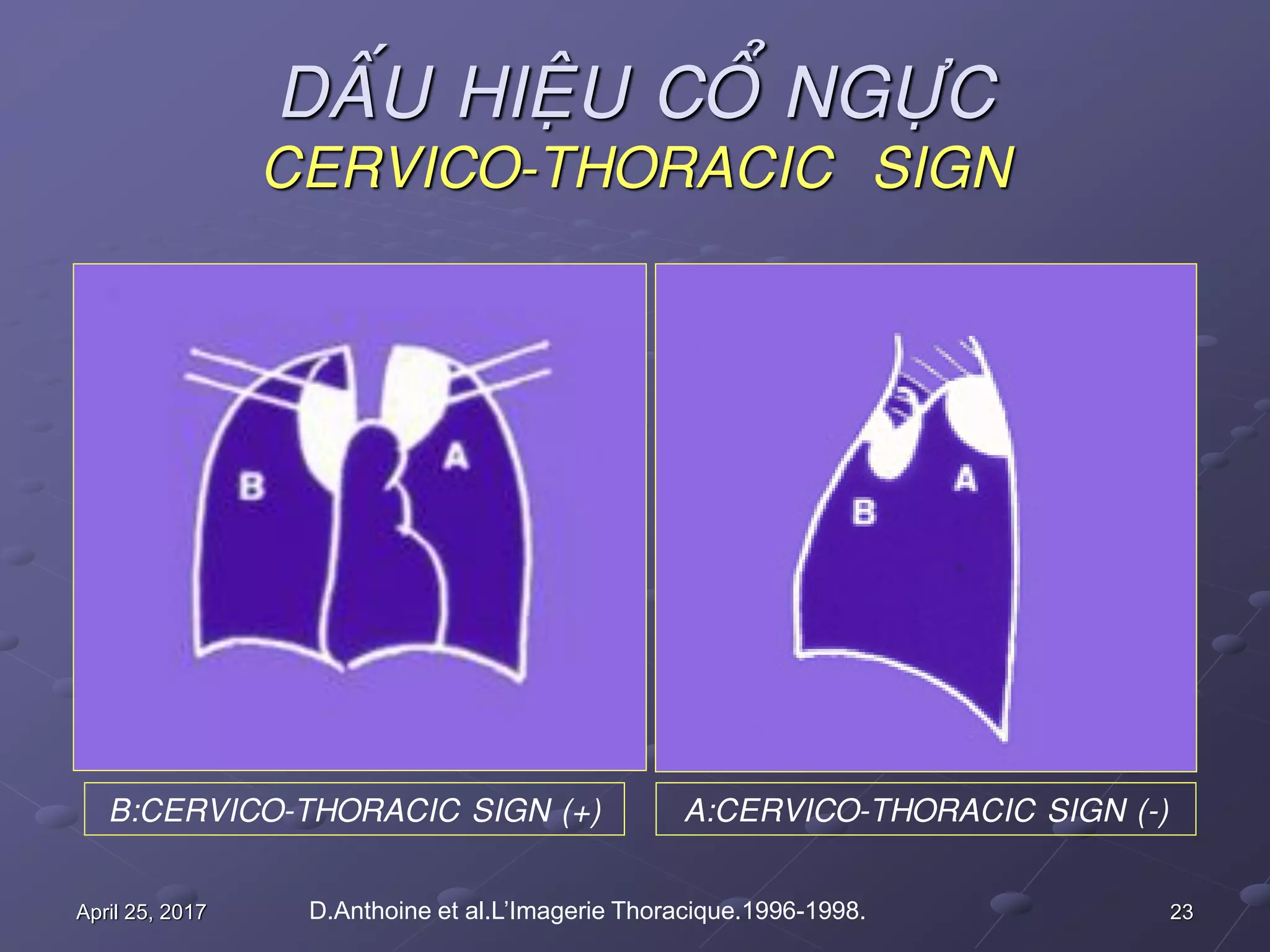 3. Chest X-ray signs | PDF