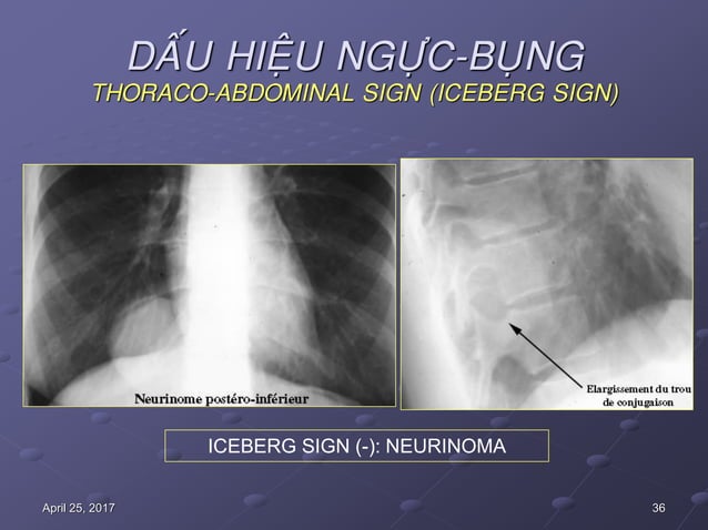 3. Chest X-ray signs | PDF