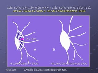 3. Chest X-ray signs | PDF
