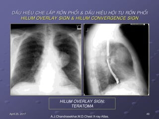 3. Chest X-ray signs | PDF