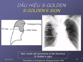 3. Chest X-ray signs | PDF