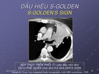3. Chest X-ray signs | PDF