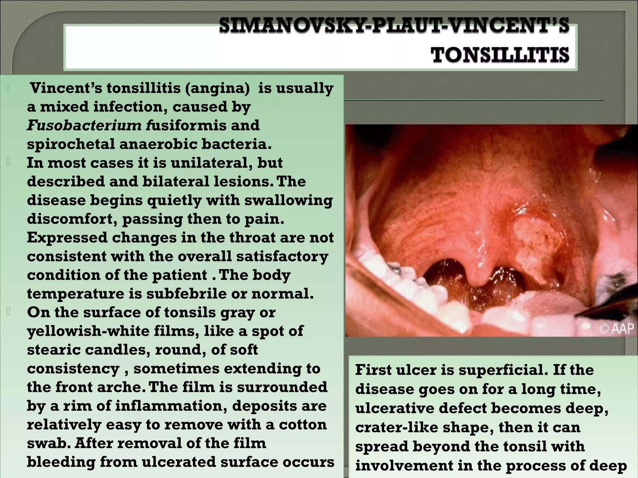 Tonsillitis syndrome in children. Diphtheria | PPT
