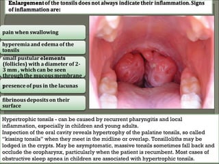 Tonsillitis syndrome in children. Diphtheria | PPT