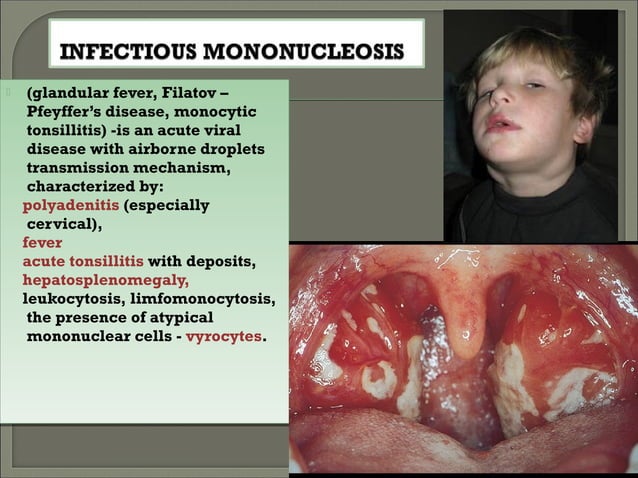 Tonsillitis syndrome in children. Diphtheria