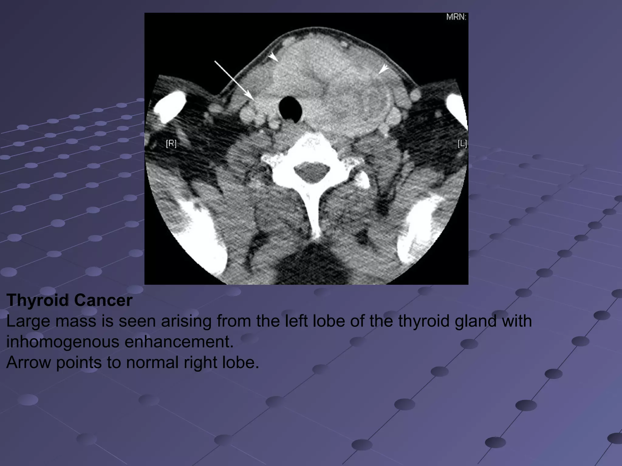 Radiation diagnosis of Thyroid diseases | PPT