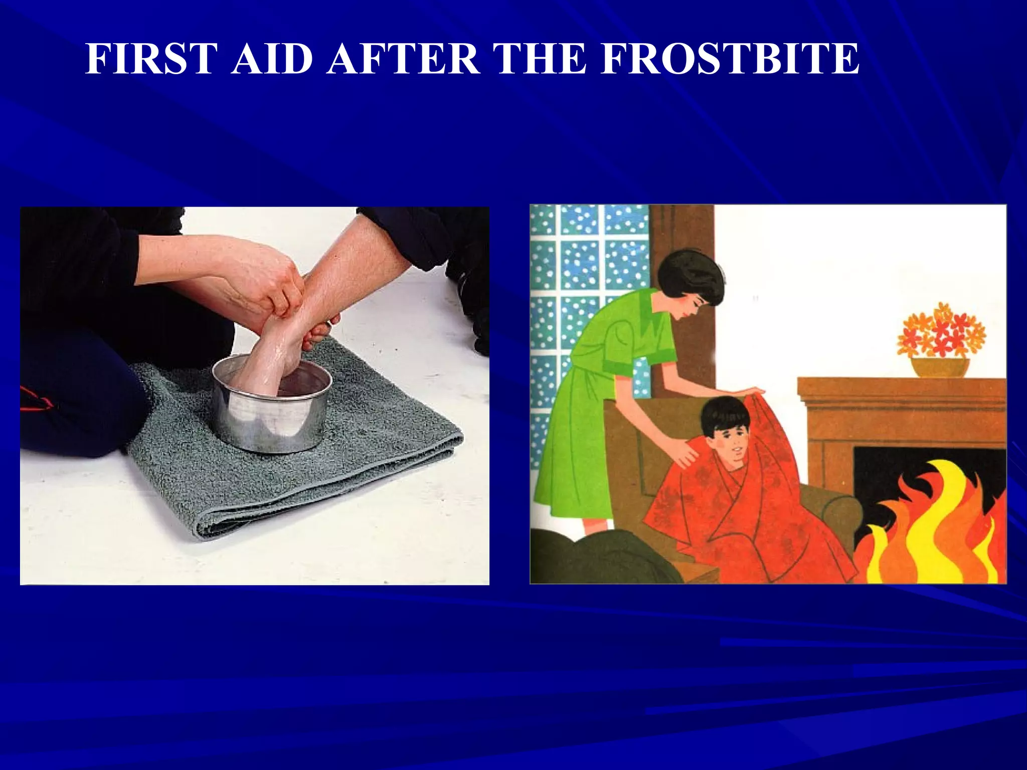 Thermal Trauma. Burns, Electrical Trauma, Frost Bite | PPT