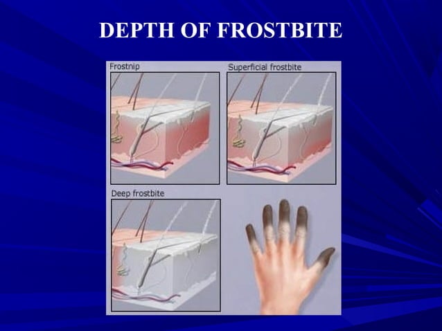 Thermal Trauma. Burns, Electrical Trauma, Frost Bite | PPT